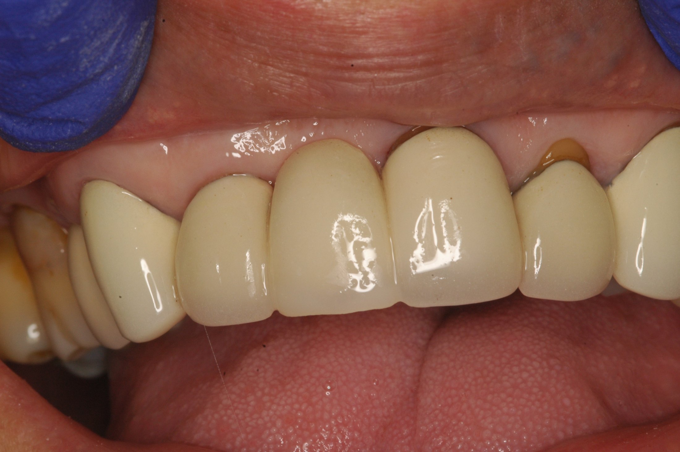 Emergency Help! I slipped, fell and broke my front tooth.